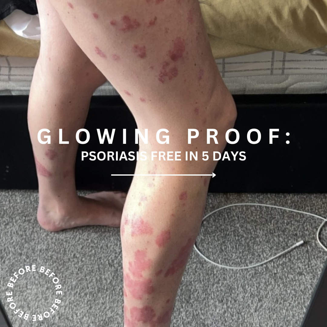 Healing Power of Sea Moss for Psoriasis – Suave Moss Lifestyle